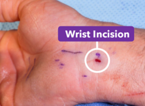 Carpal Tunnel Treatment - Winchester Radiologists