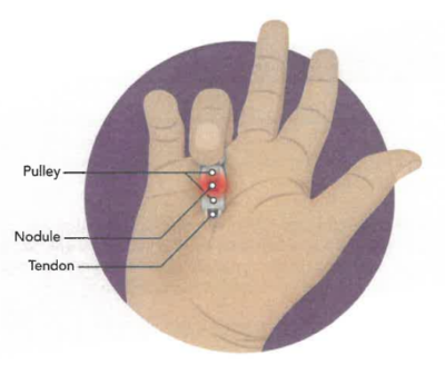Benefits of Trigger Finger Release - Winchester Radiologists
